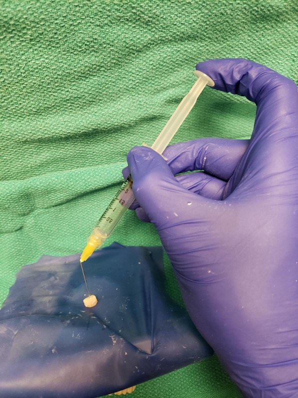 UNMC dentist identifies new uses for Precision Syringe - UNeTech Institute